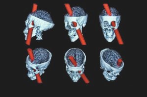 Phineas Gage, The Man Who Survived a Hole Through His Head